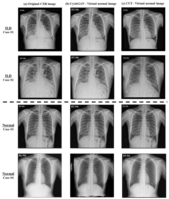 Pixel-Wise Interstitial Lung Disease Interval Change Analysis: A ...