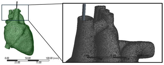 Advancements in Finite Element Modeling for Cardiac Device Leads and 3D Heart Models