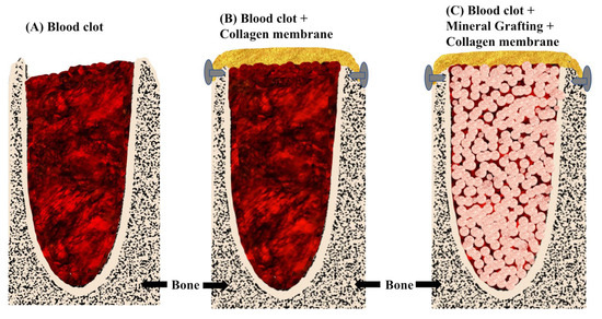 Bioengineering | Free Full-Text | Changes of the Alveolar Bone Ridge ...