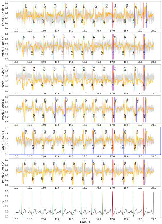 Automated Heart Rate Detection in Seismocardiograms Using Electrocardiogram-Based Algorithms—A ...