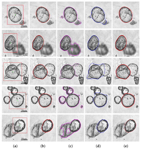 A Convexity-Preserving Level-Set Method for the Segmentation of Tumor ...