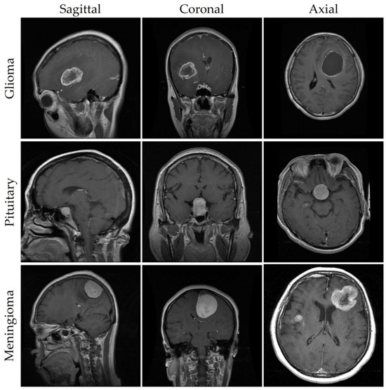 Enhancing Automated Brain Tumor Detection Accuracy Using Artificial ...