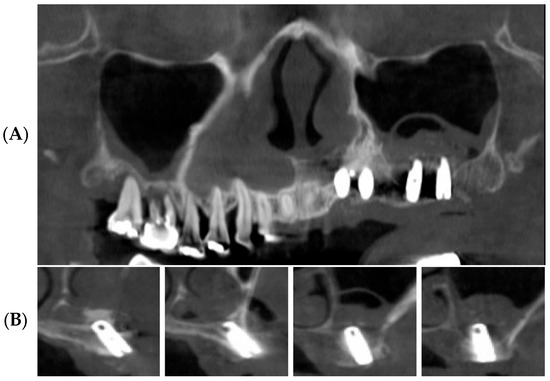 Retrospective Study of Maxillary Sinus Augmentation Using Demineralized ...