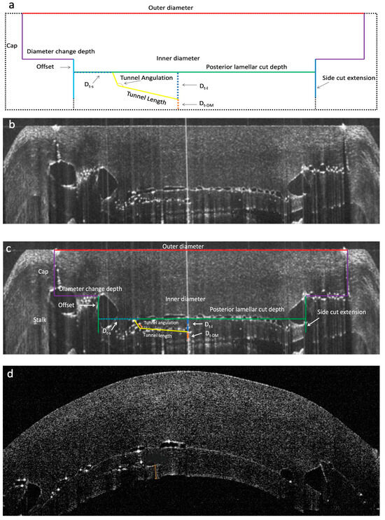 One-Step Intraoperative Optical Coherence Tomography Guided Tunnel ...