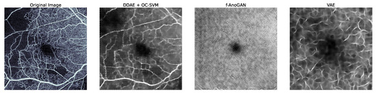 Anomaly Detection in Optical Coherence Tomography Angiography (OCTA) with a Vector-Quantized ...
