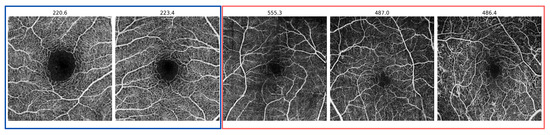 Anomaly Detection in Optical Coherence Tomography Angiography (OCTA) with a Vector-Quantized ...