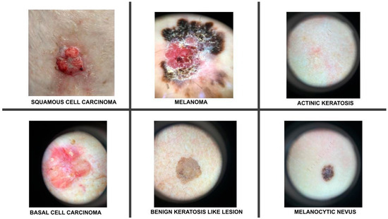 Enhancing Dermatological Diagnostics with EfficientNet: A Deep Learning ...
