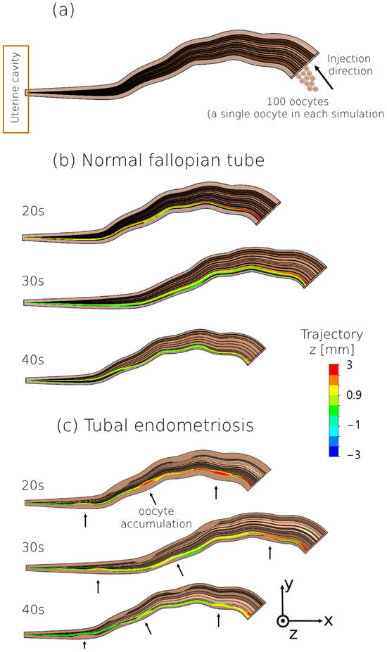 The Synergic Effect of Tubal Endometriosis and Women’s Aging on ...