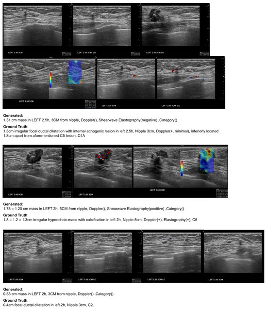 AI-Powered Synthesis of Structured Multimodal Breast Ultrasound Reports ...
