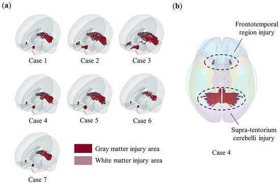An Objective Injury Threshold for the Maximum Principal Strain ...