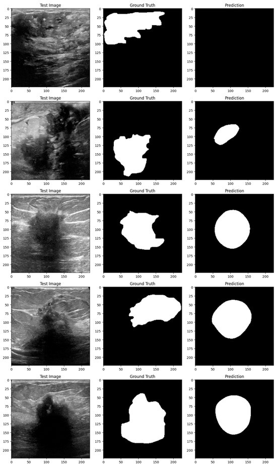 EfficientUNetViT: Efficient Breast Tumor Segmentation Utilizing UNet ...