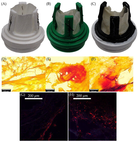 Computational Model for Early-Stage Aortic Valve Calcification Shows Hemodynamic Biomarkers