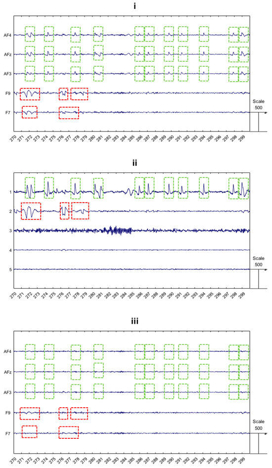 Optimizing EEG Signal Integrity: A Comprehensive Guide to Ocular Artifact Correction