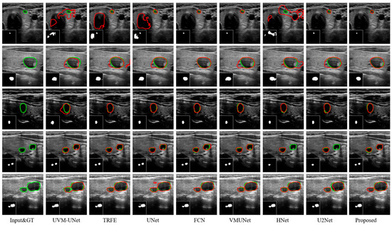 Mamba- and ResNet-Based Dual-Branch Network for Ultrasound Thyroid Nodule Segmentation