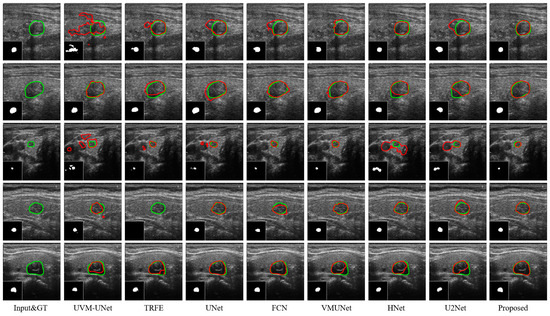 Mamba- and ResNet-Based Dual-Branch Network for Ultrasound Thyroid Nodule Segmentation