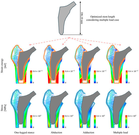 Personalized Stem Length Optimization in Hip Replacement: A Microscopic ...