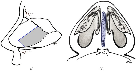 Human Septal Cartilage Tissue Engineering: Current Methodologies and ...