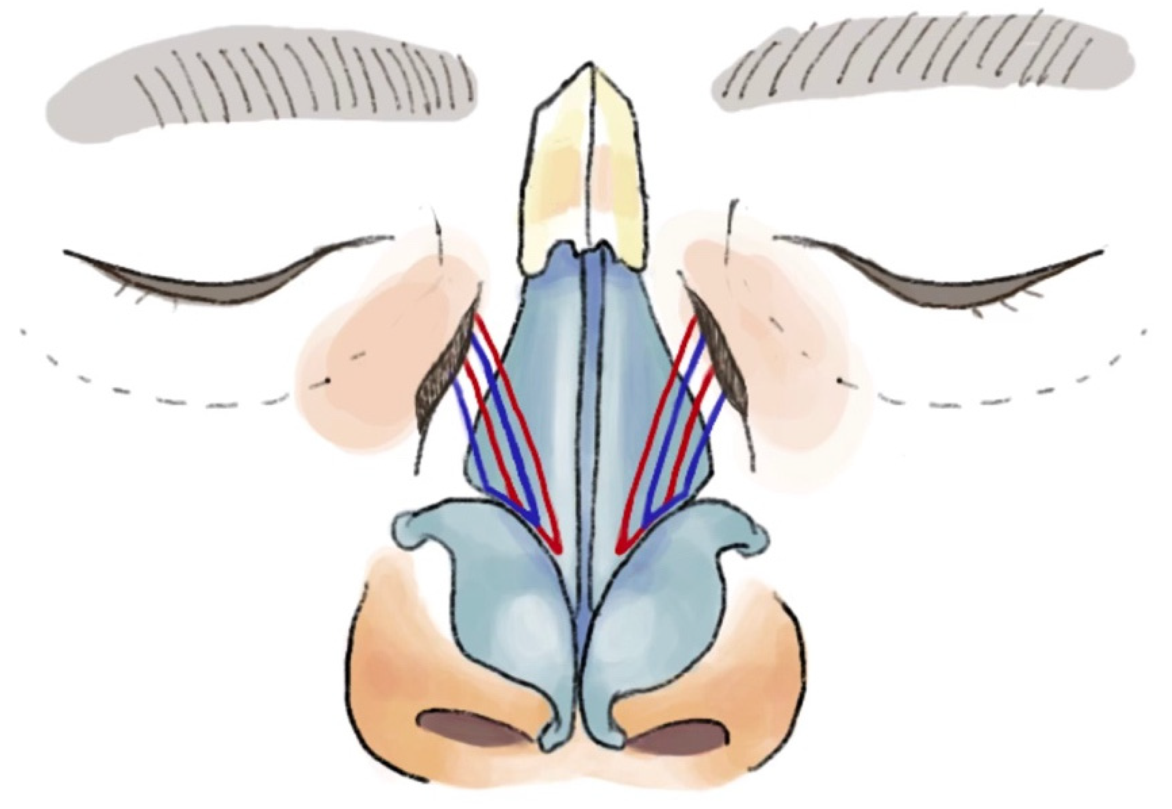 A Repair Technique for Internal Nasal Valve Collapse Using Lateral ...