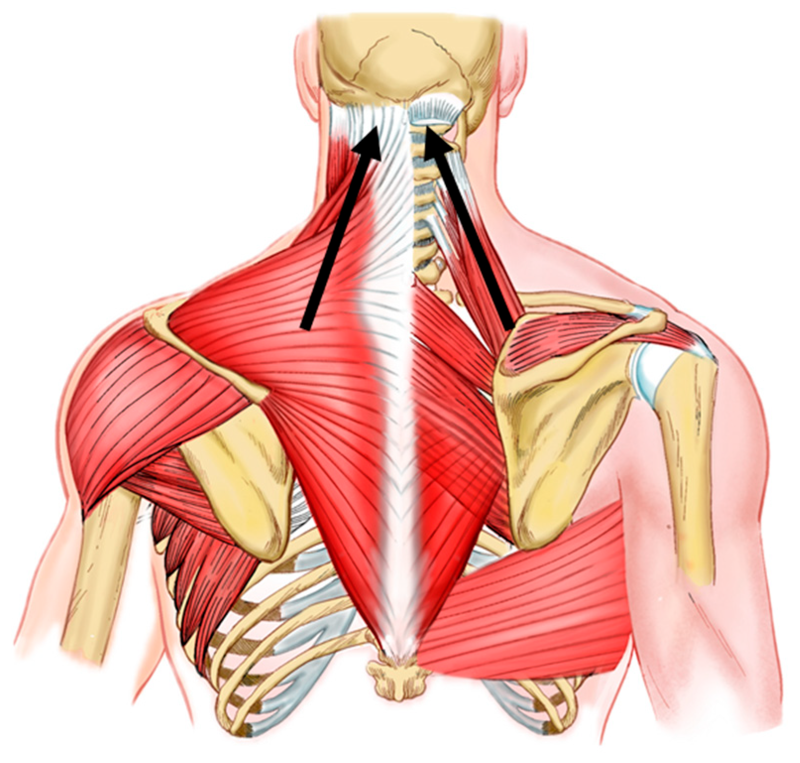 Upper Crossed Syndrome and Scapulae Upper-Trapping: A Mesotherapy Protocol in ...