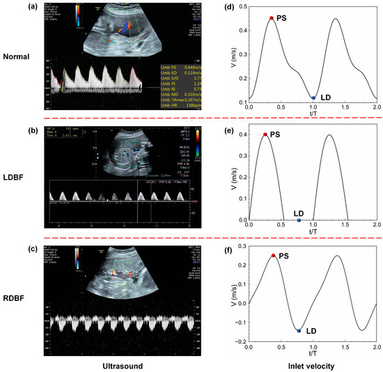 Analysis of Umbilical Artery Hemodynamics in Development of ...