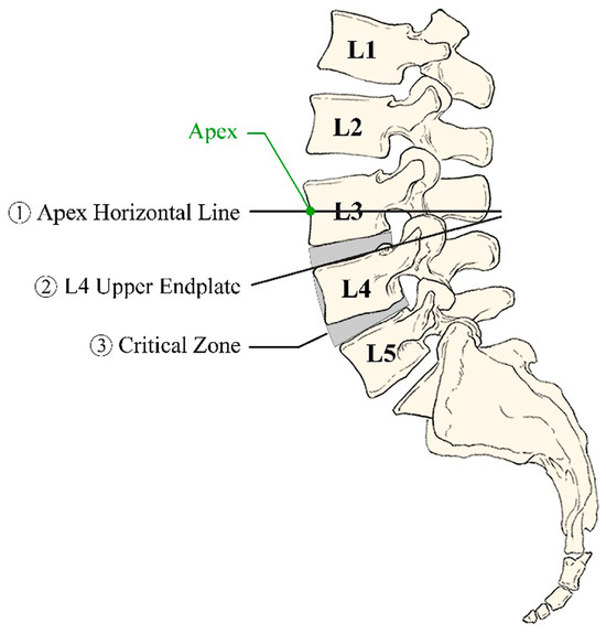 Defining a Critical Partition Zone for Sagittal Alignment in Lumbar ...
