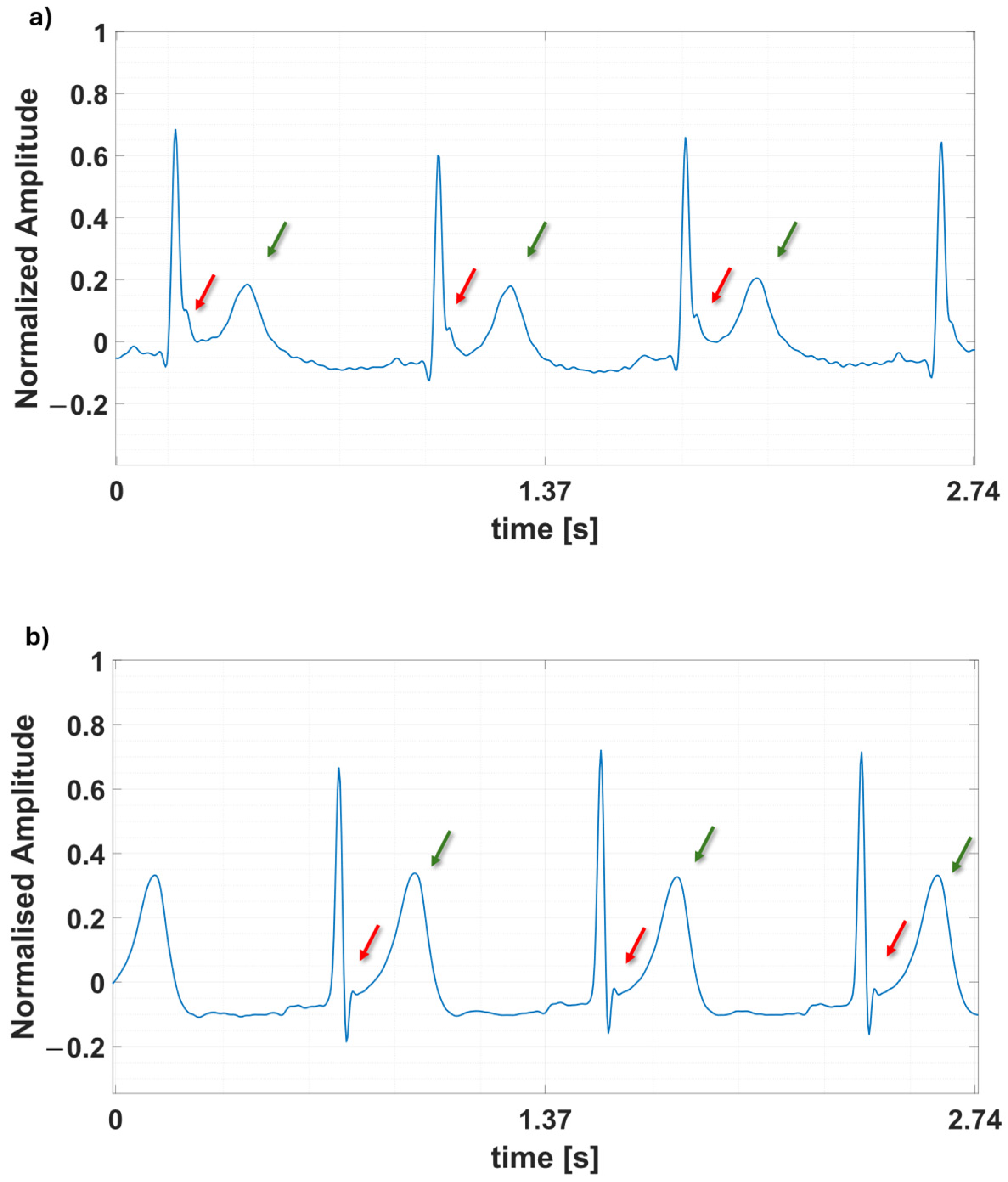 Edge-AI Enabled Wearable Device for Non-Invasive Type 1 Diabetes ...