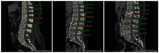 Enhanced Detection Performance of Acute Vertebral Compression Fractures ...