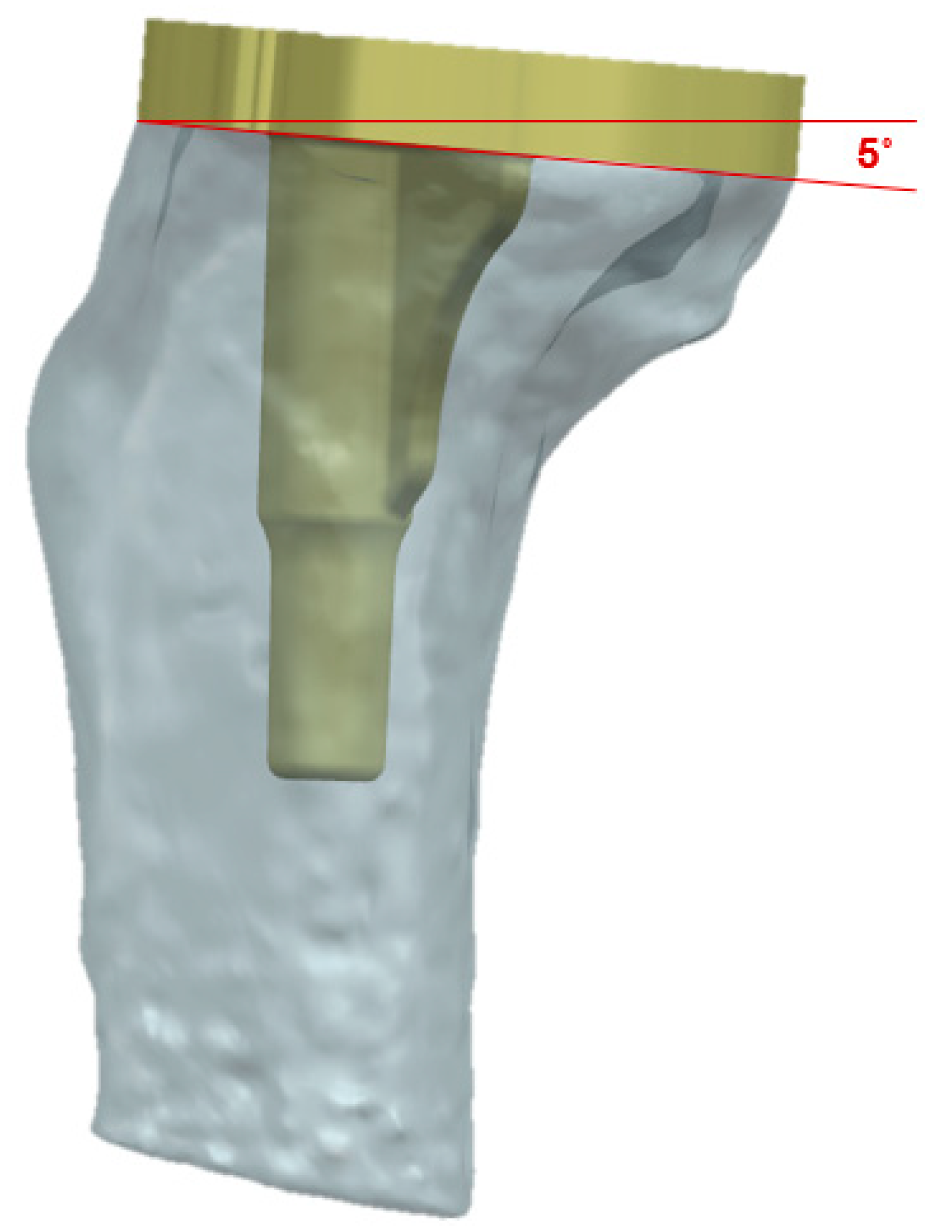 Optimization of Tibial Stem Geometry in Total Knee Arthroplasty Using ...