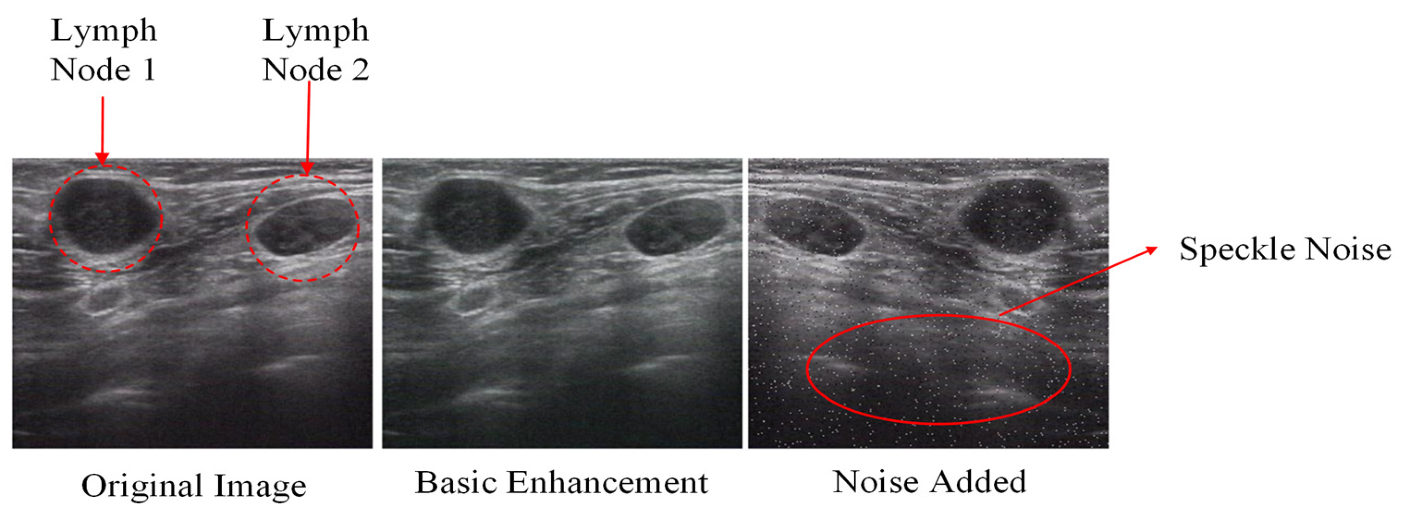 Semantic-Attention Enhanced DSC-Transformer for Lymph Node Ultrasound Classification and Remote ...