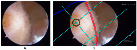 Marker-Less Navigation System for Anterior Cruciate Ligament ...