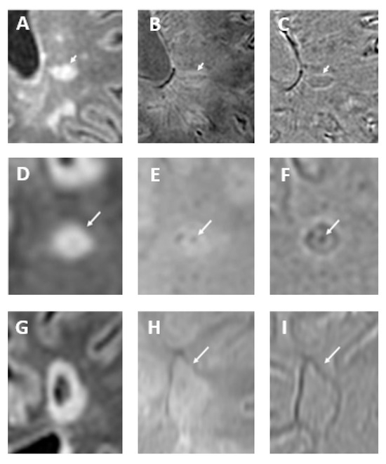 Susceptibility-Weighted Imaging (SWI): Technical Aspects and ...