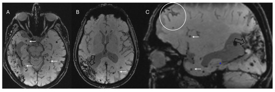 Susceptibility-Weighted Imaging (SWI): Technical Aspects and ...