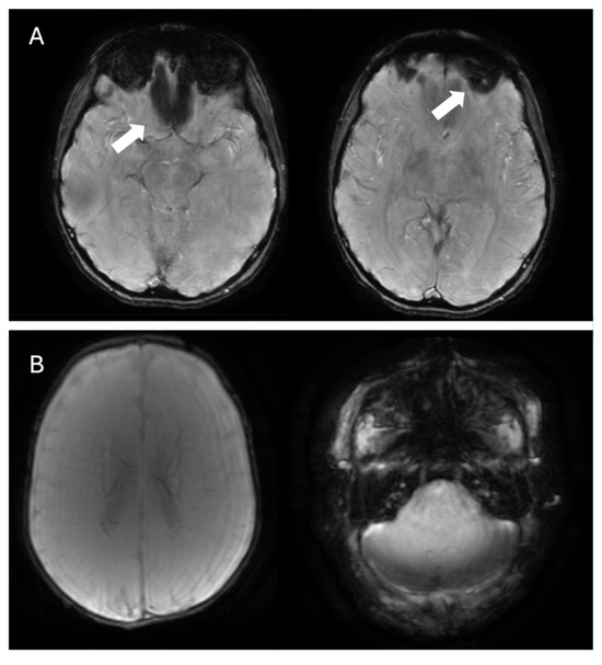Susceptibility-Weighted Imaging (SWI): Technical Aspects and ...