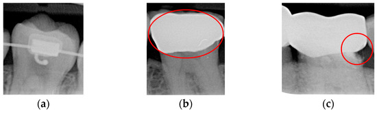 Automated Caries Detection Under Dental Restorations and Braces Using Deep Learning