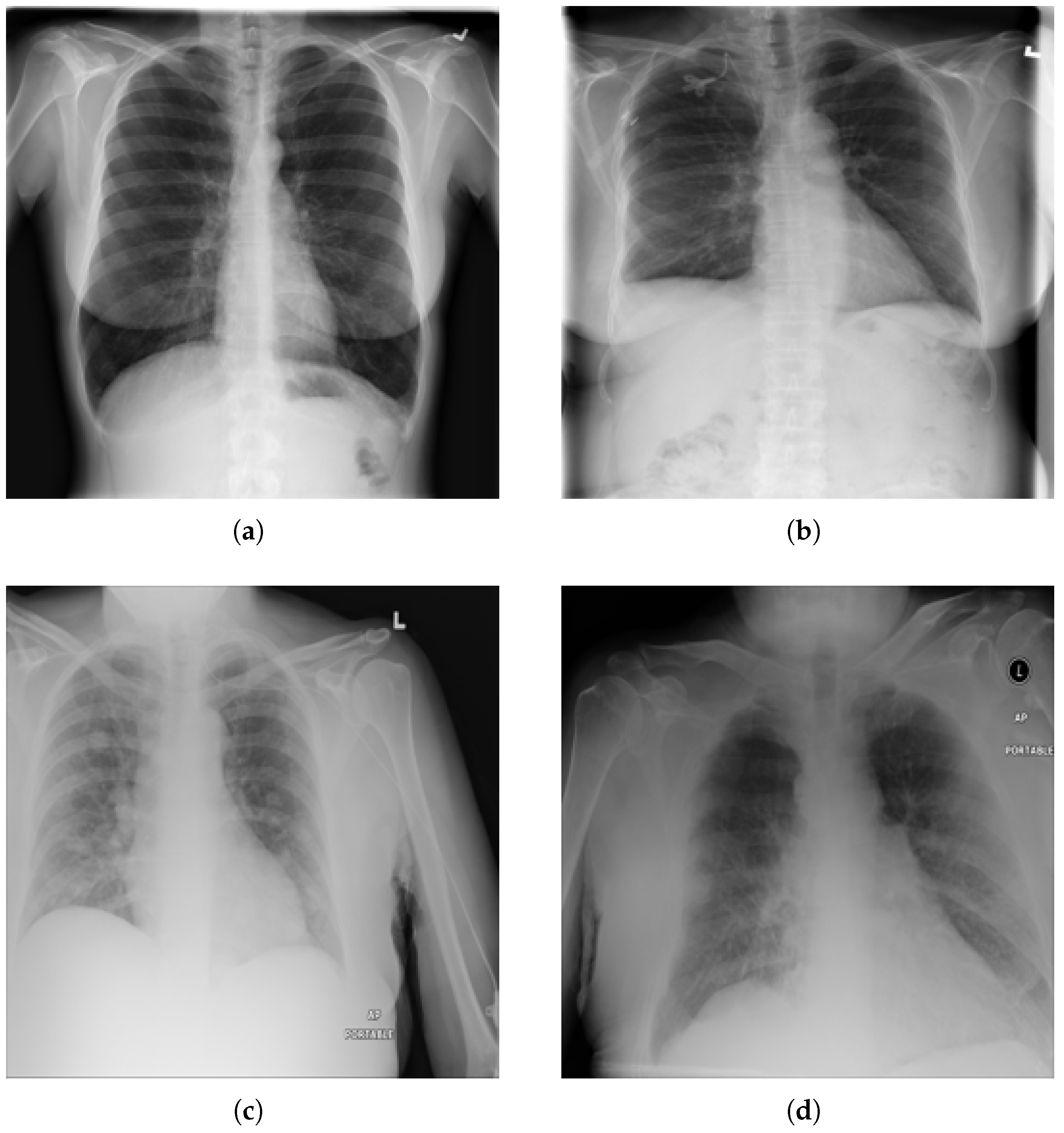 Enhancing Multi-Label Chest X-Ray Classification Using an Improved Ranking Loss