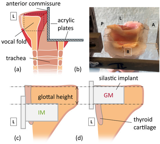 Dynamically Quantifying Vocal Fold Thickness: Effects of Medialization ...