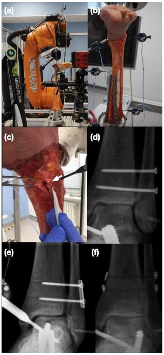 Flexible Syndesmotic Reconstruction with Two Suture Buttons Provides ...