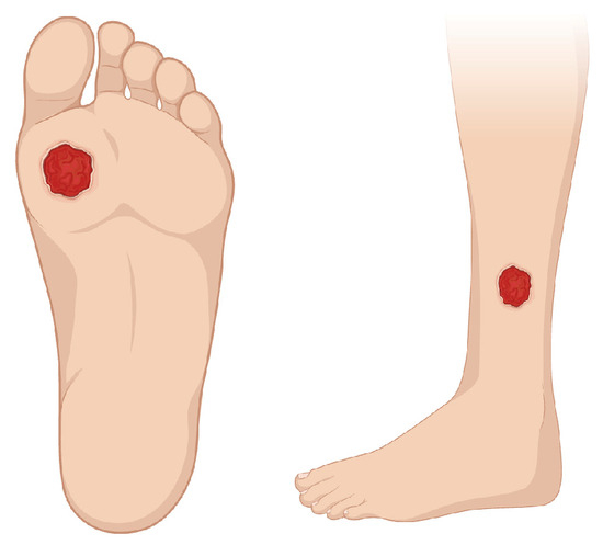 Curcumin-Loaded Drug Delivery Systems for Acute and Chronic Wound ...