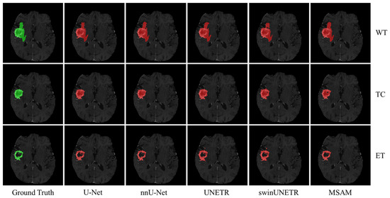 Segmentation of Brain Tumors Using a Multi-Modal Segment Anything Model (MSAM) with Missing ...