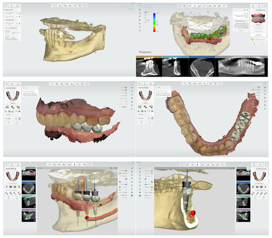 Digital Technologies in Implantology: A Narrative Review