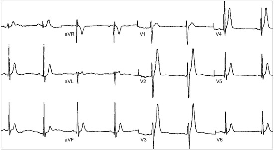Biology | Free Full-Text | Cardiac Channelopathies and Sudden Death ...