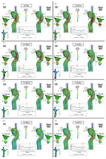 Biology | Free Full-Text | Fluid-Structure Interaction Simulation of an Intra-Atrial Fontan ...