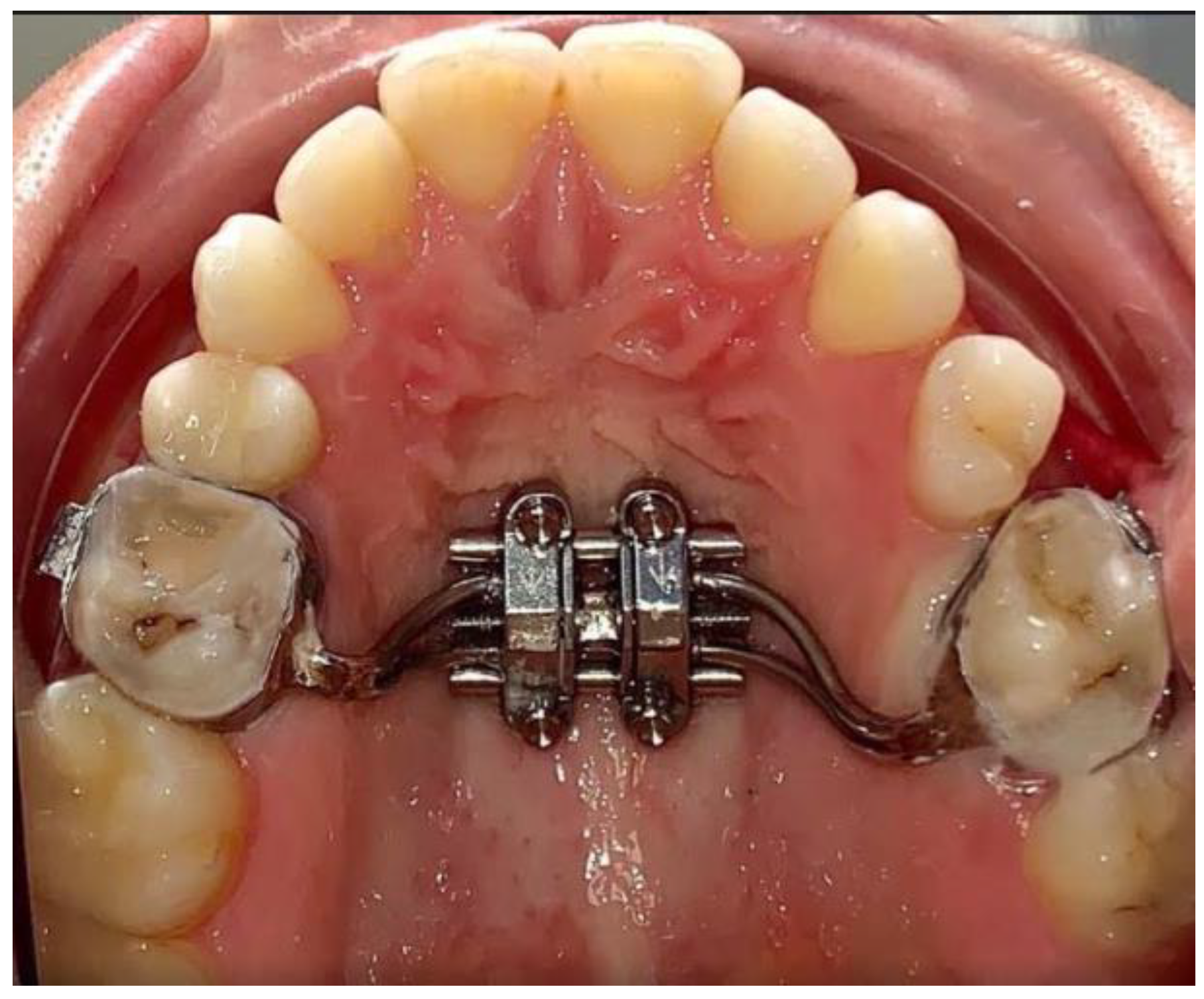 Observational Study Regarding Possible Side Effects of Miniscrew ...