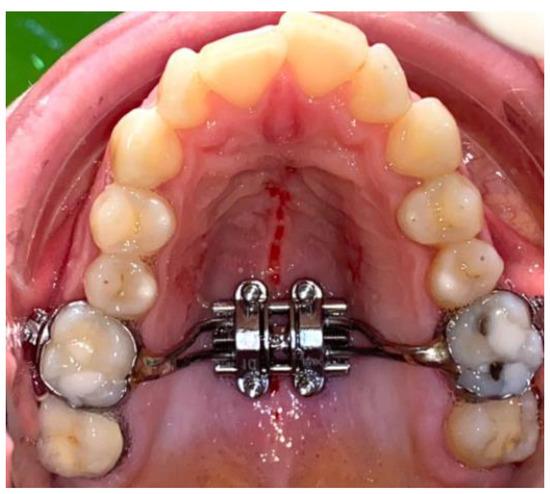 Observational Study Regarding Possible Side Effects of Miniscrew ...