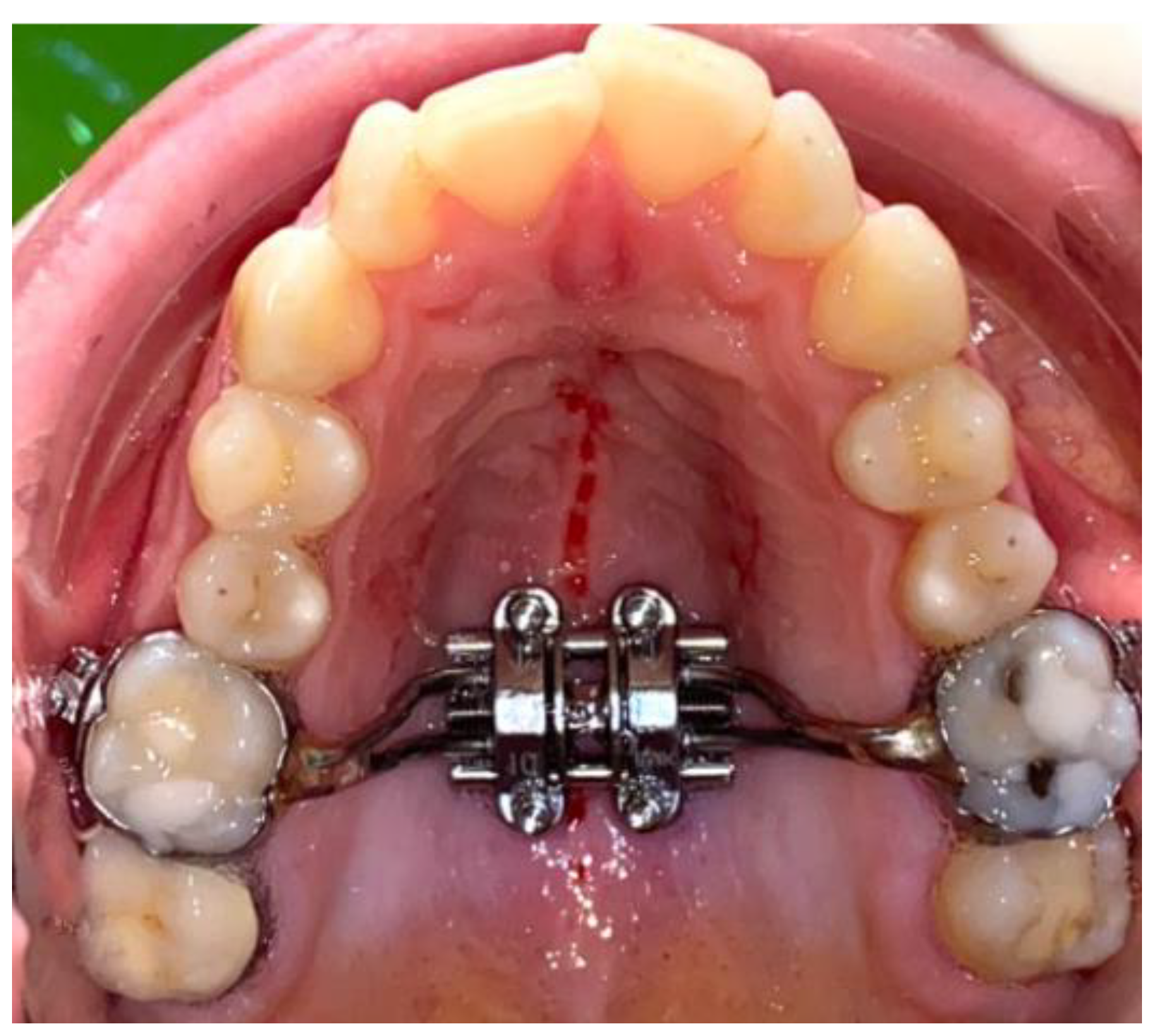 Observational Study Regarding Possible Side Effects of Miniscrew ...