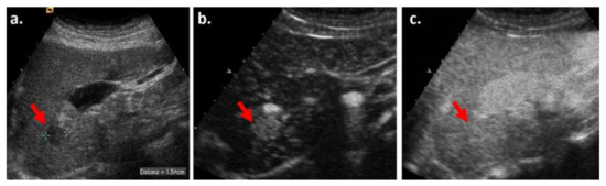 CT/MRI LI-RADS v2018 vs. CEUS LI-RADS v2017—Can Things Be Put Together?