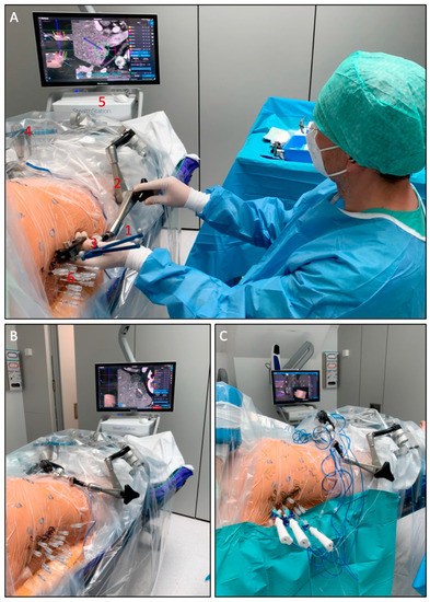 Biology | Free Full-Text | Stereotactic Thermal Ablation of Liver ...