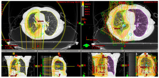 Use of Continuous Positive Airway Pressure (CPAP) to Limit Diaphragm ...