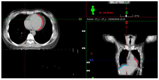 Use of Continuous Positive Airway Pressure (CPAP) to Limit Diaphragm ...