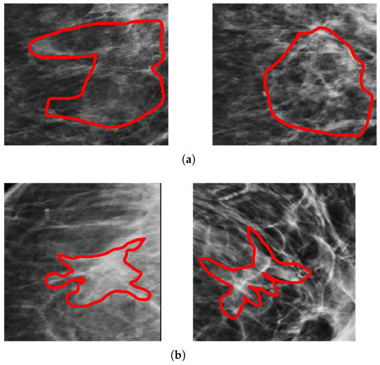 Architectural Distortion-Based Digital Mammograms Classification Using Depth Wise Convolutional ...